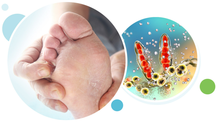 Podiatric Treatment for Athlete's Foot | Northstate Foot and Ankle