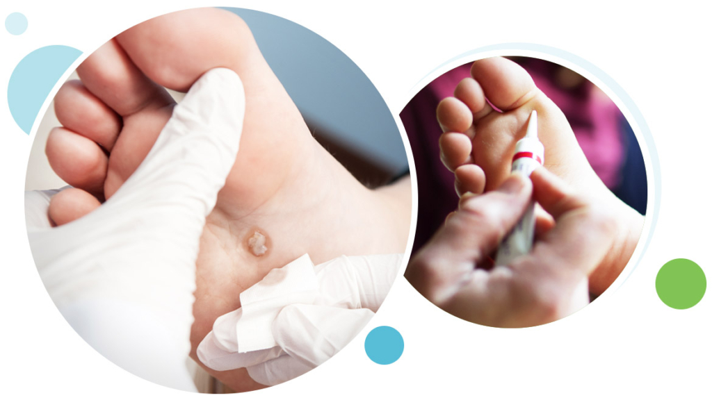 Plantar Wart Removal and Treatement | Northstate F&AS Podiatrists