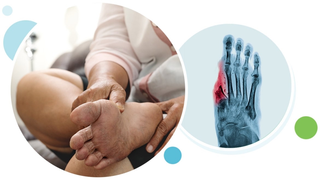 Midfoot/Forefoot Arthritis - Northstate Foot and Ankle Specialists